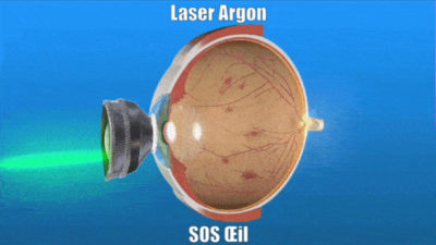 Thérapie au Laser des yeux | CNVO | Yverdon-les-Bains