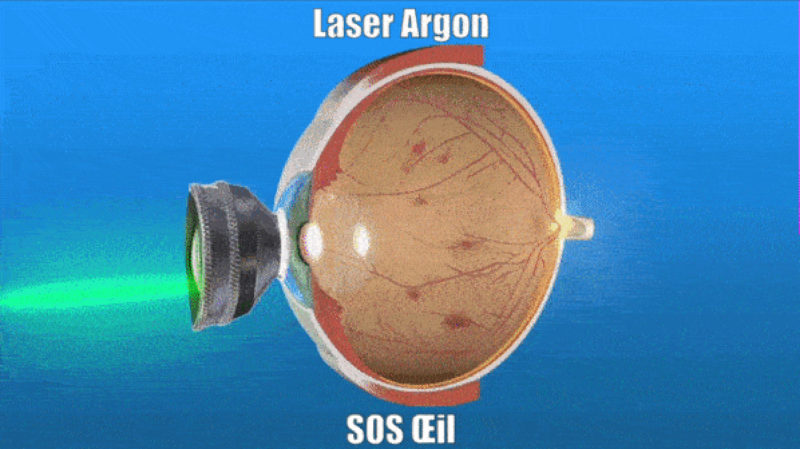 Eye Laser Therapy | CNVO | Yverdon-les-Bains